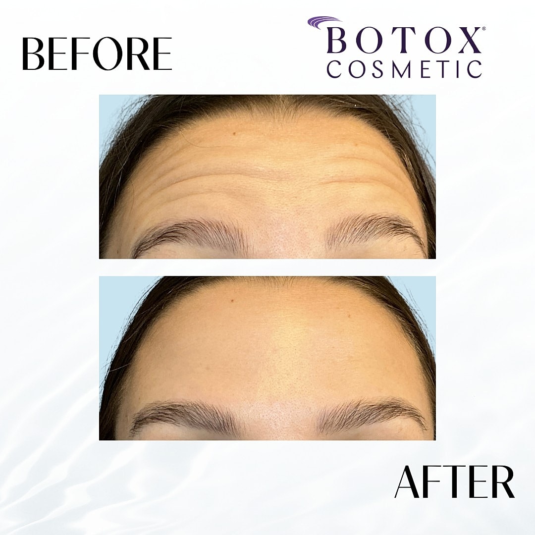 Botox Denver | Best Botox Injections Denver, CO | Rejuvenate Medspa